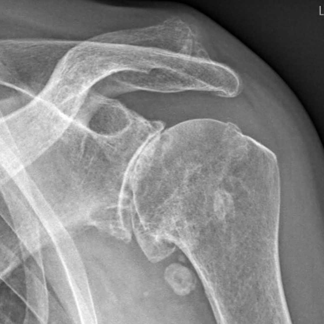 Schouder | Orthoclinic - Orthopedie Brugge