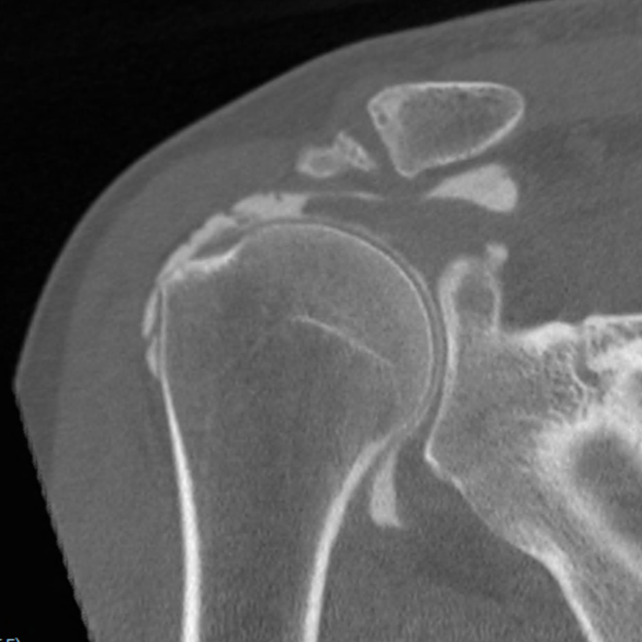 Schouder | Orthoclinic - Orthopedie Brugge