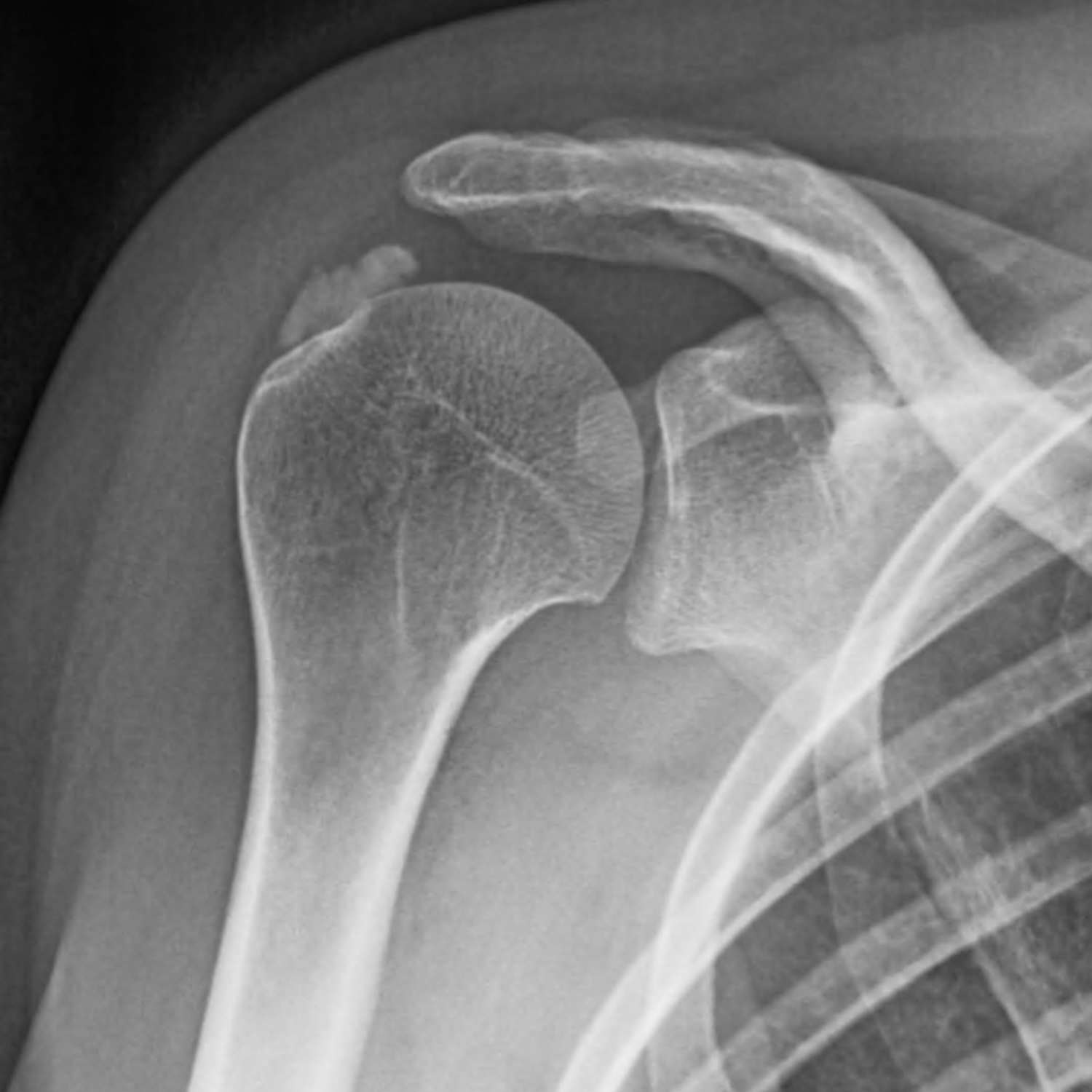 Schouder | Orthoclinic - Orthopedie Brugge