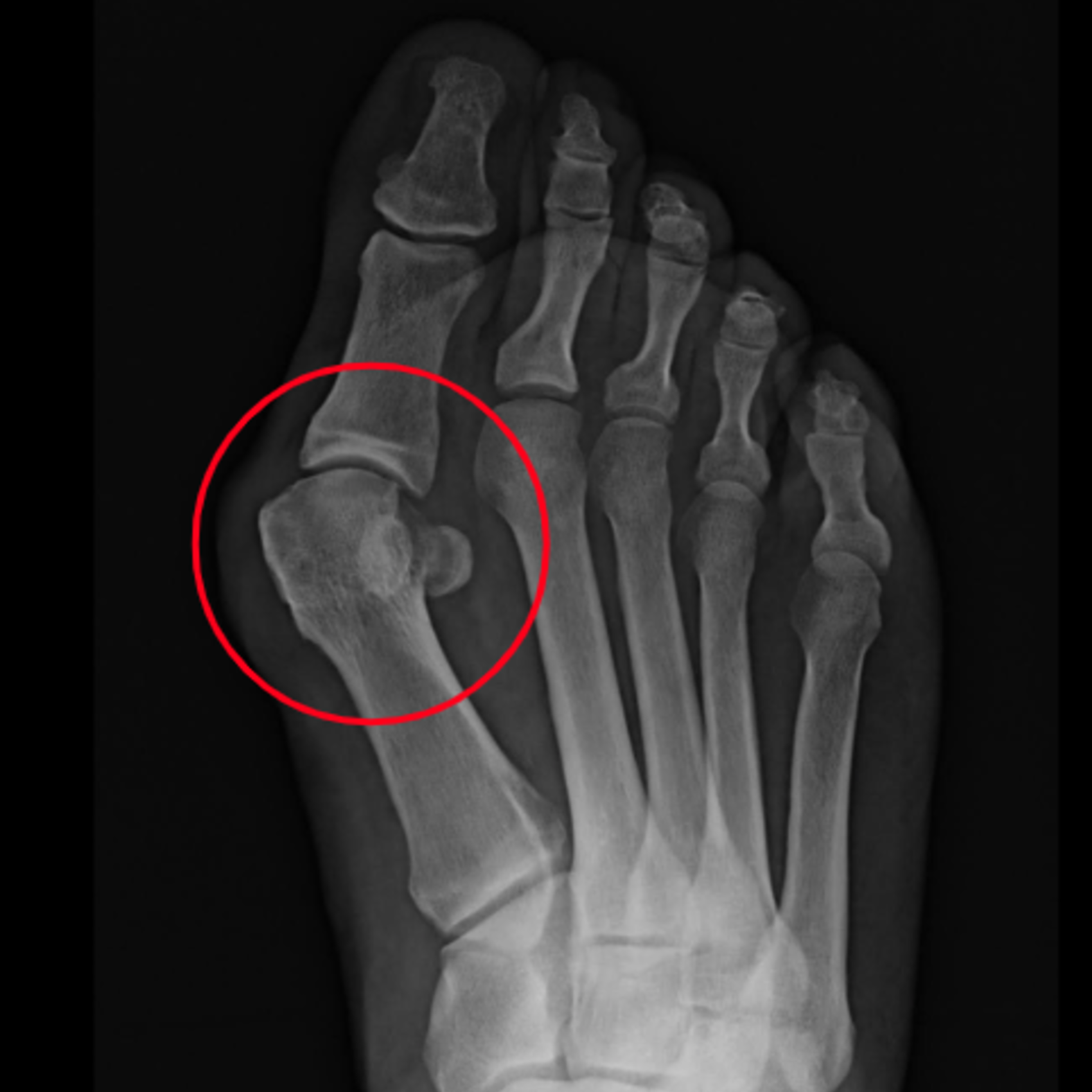 Voet & enkel | Orthoclinic - Orthopedie Brugge