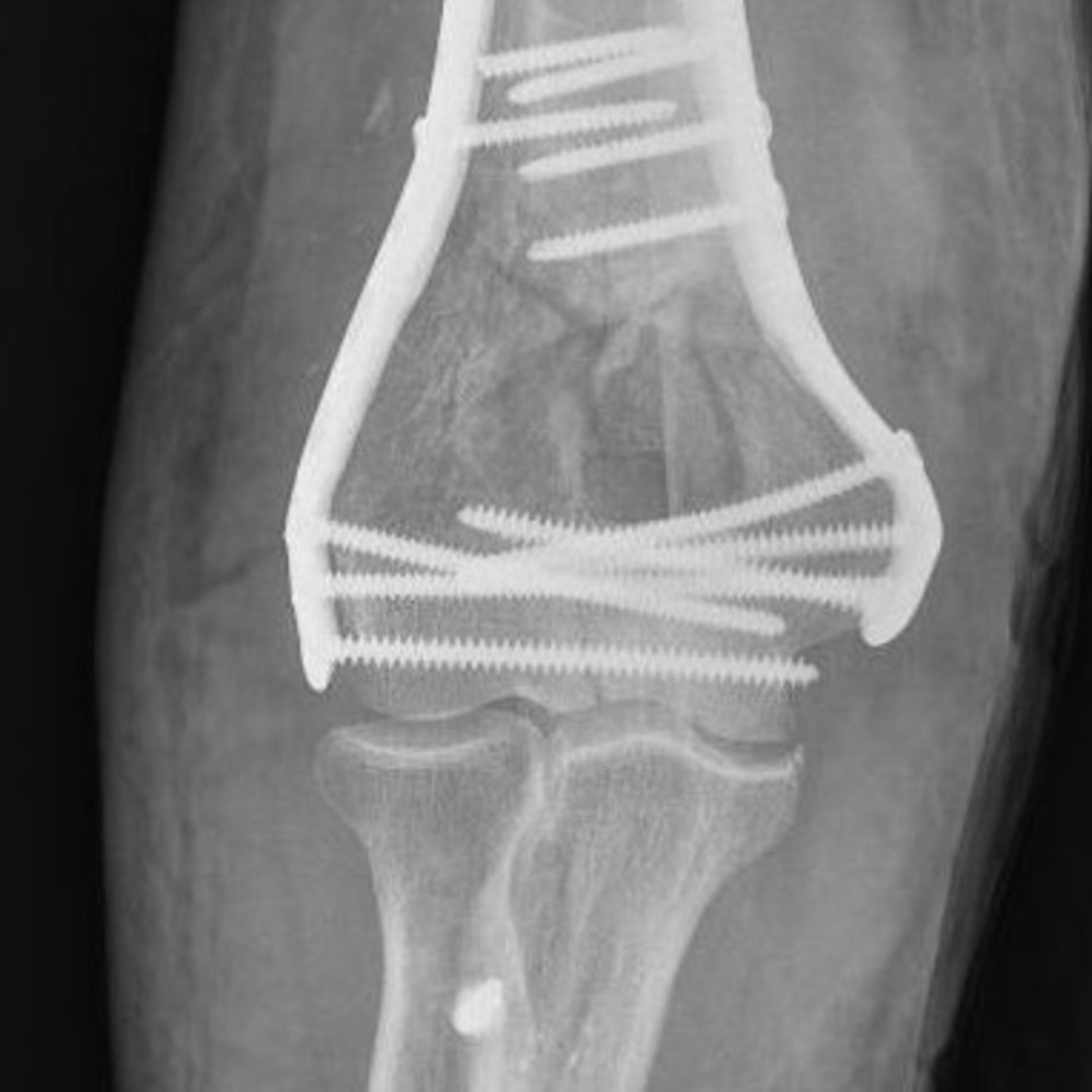 Elleboog | Orthoclinic - Orthopedie Brugge