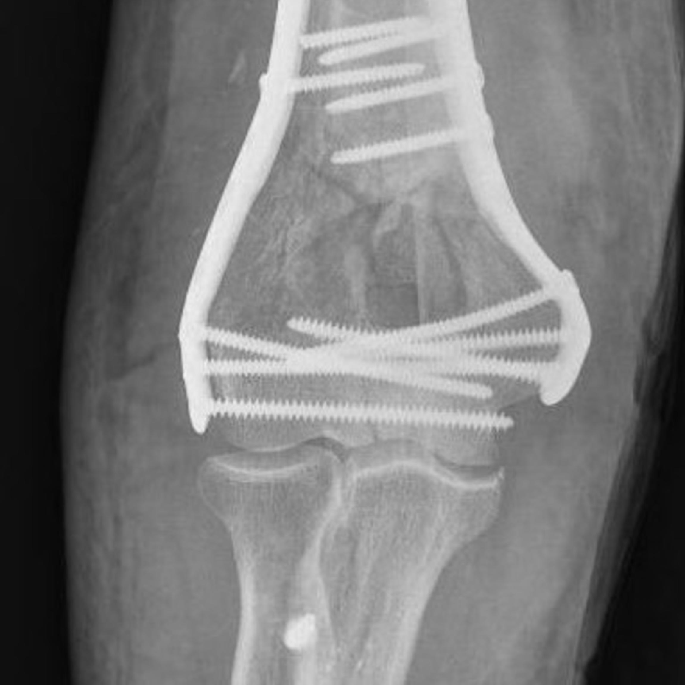 Elleboog | Orthoclinic - Orthopedie Brugge