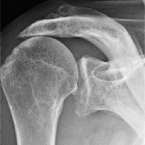 Schouder | Orthoclinic - Orthopedie Brugge