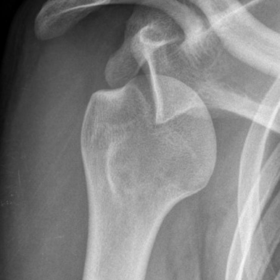 Schouder | Orthoclinic - Orthopedie Brugge