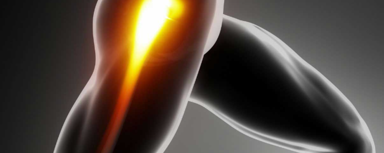 Bursitis trochanterica | Orthoclinic - Orthopedie Brugge