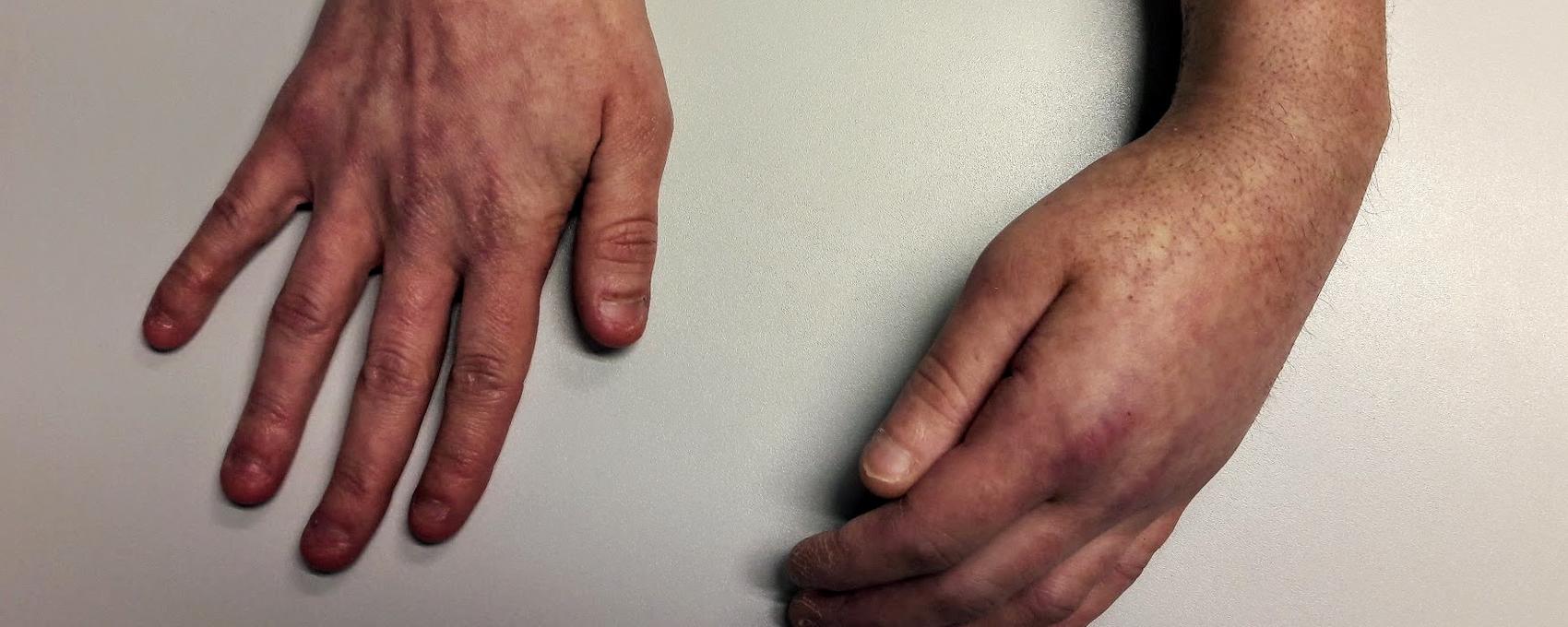 Sudeck dystrofie | Orthoclinic - Orthopedie Brugge
