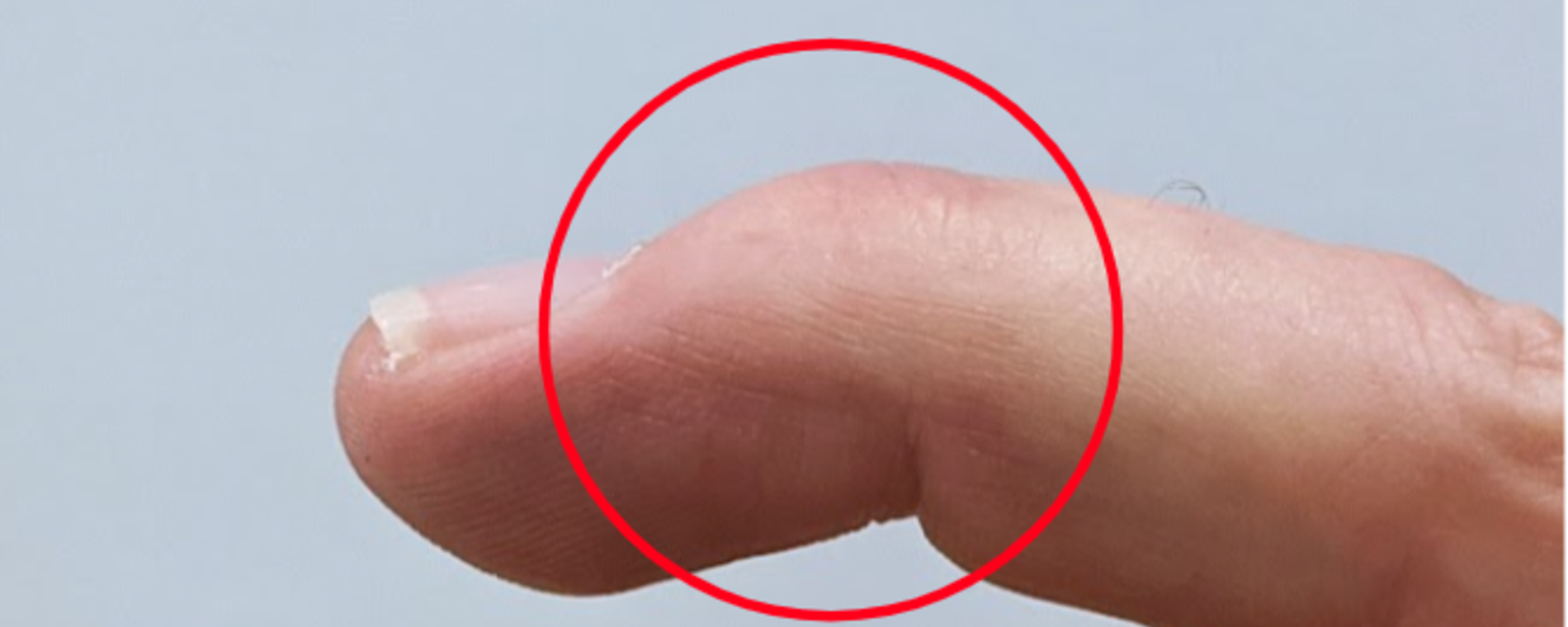 Mallet vinger | Orthoclinic - Orthopedie Brugge