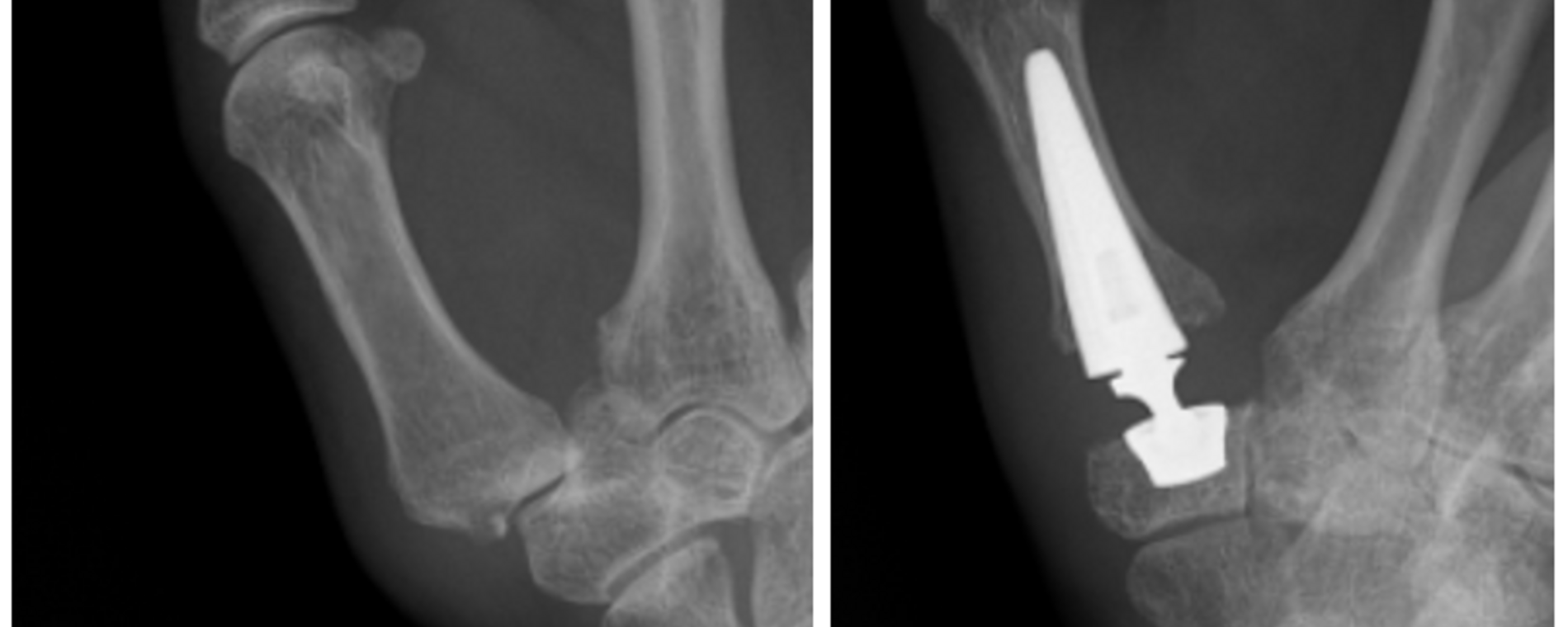 Duimbasisprothese | Orthoclinic Brugge