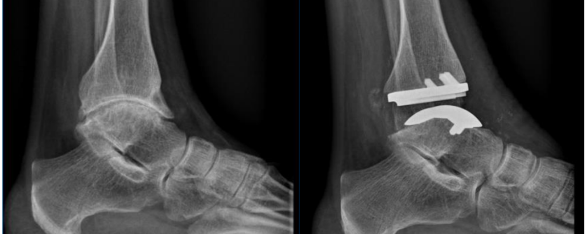 Nieuwe technologie: Enkelprothese | Orthoclinic - Orthopedie Brugge