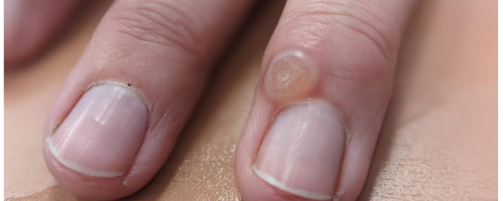 Mucoid cyste | Orthoclinic Brugge