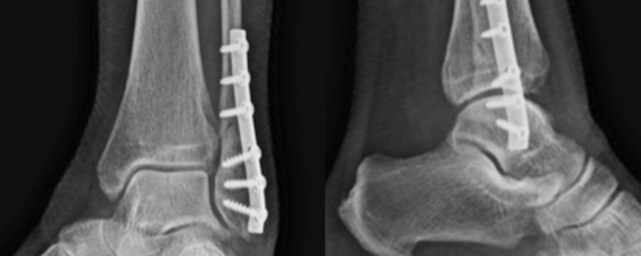 Herstel enkelbreuk | Orthoclinic - Orthopedie Brugge