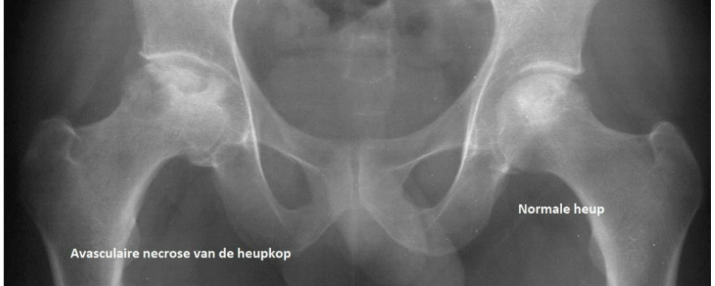 Avasculaire necrose heupkop | Orthoclinic - Orthopedie Brugge