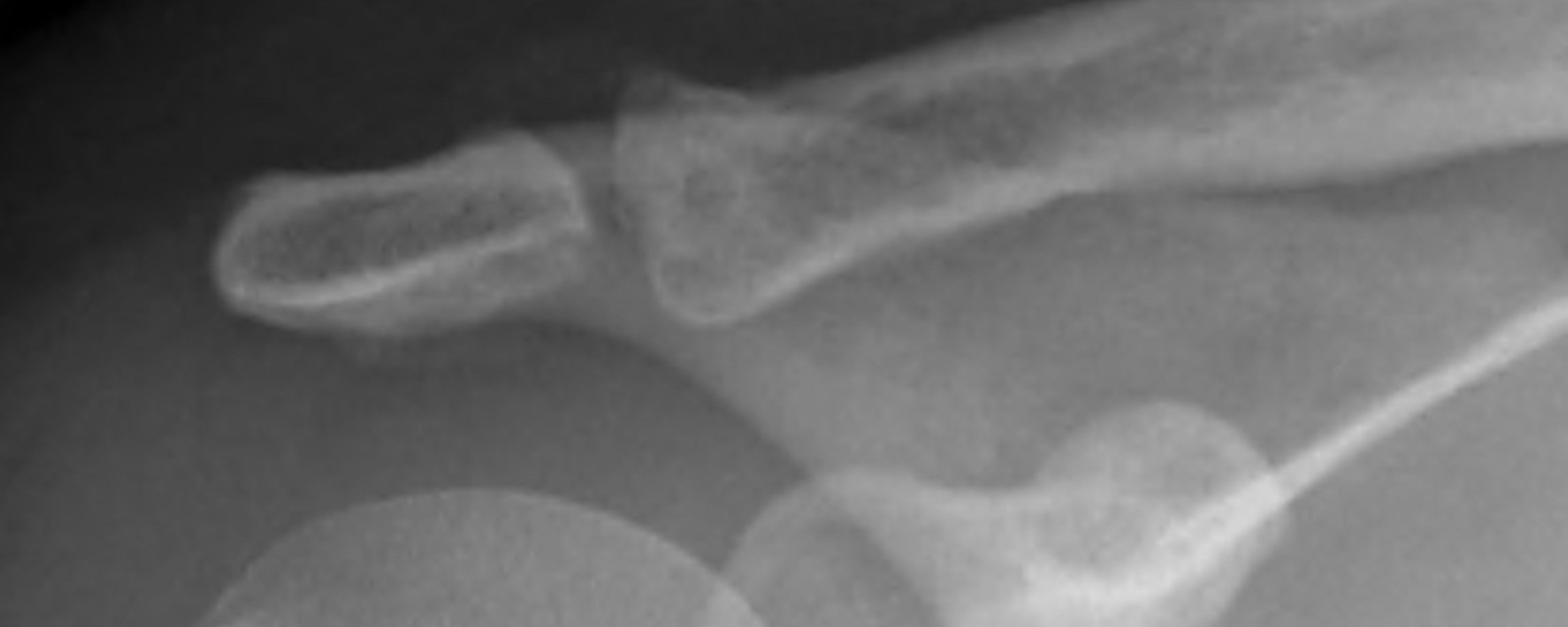 Artrose van het AC gewricht | Orthoclinic - Orthopedie Brugge