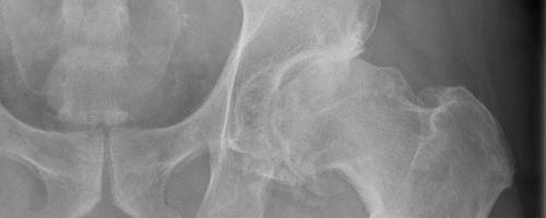 Coxartrose | Orthoclinic Brugge