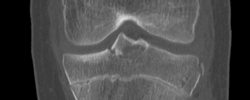 Eminentiafractuur | Orthoclinic - Orthopedie Brugge