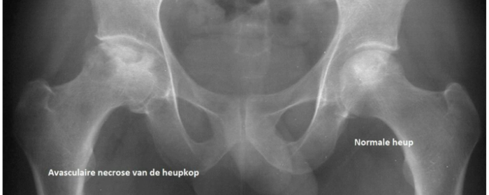 Avasculaire necrose heupkop | Orthoclinic - Orthopedie Brugge