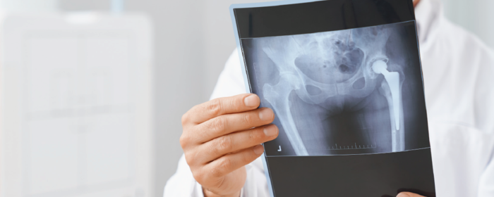 Totale heupprothese in het dagziekenhuis. | Orthoclinic - Orthopedie Brugge