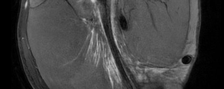 Bicepspees scheur | Orthoclinic Brugge