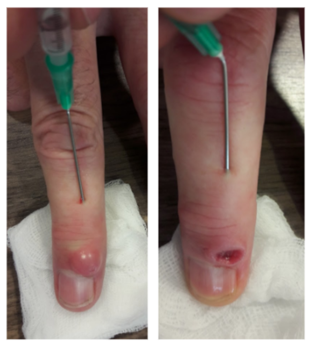 Mucoid cyste | Orthoclinic Brugge