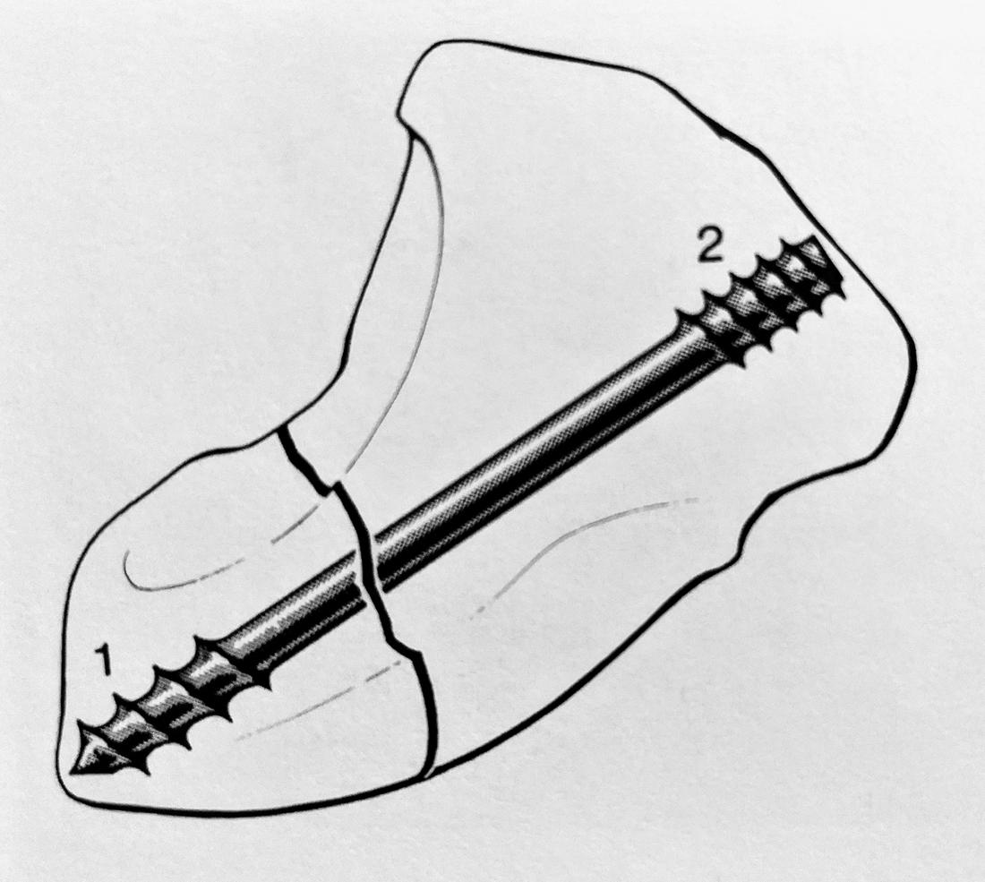 Scafoidfractuur | Orthoclinic Brugge