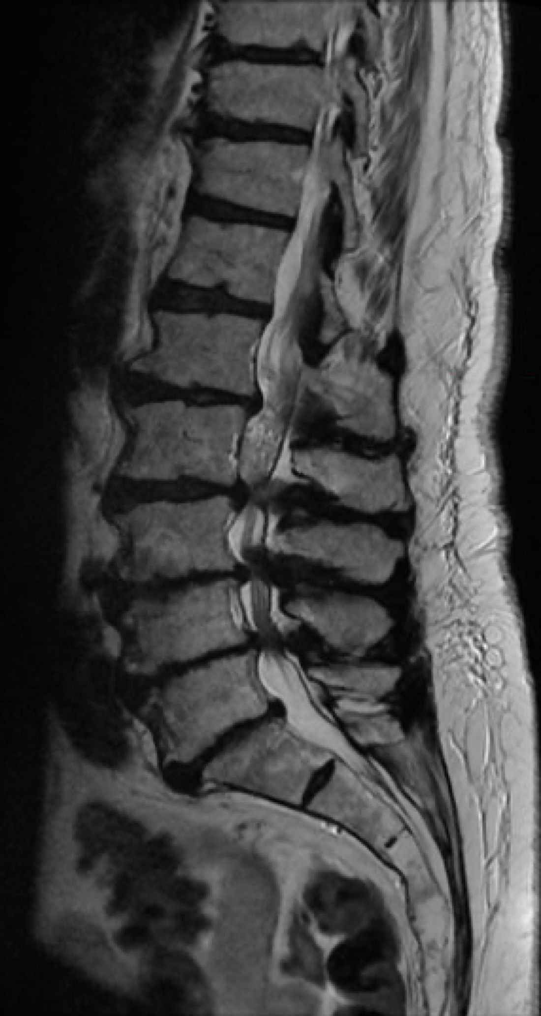 Lumbale spinaal kanaal stenose | Orthoclinic - Orthopedie Brugge