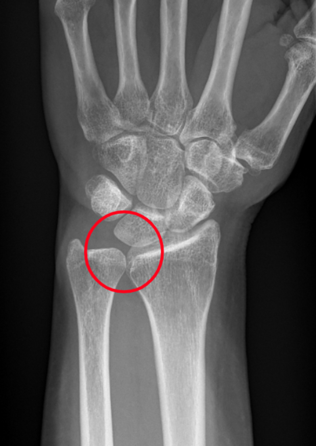 Ulnair impactie syndroom | Orthoclinic - Orthopedie Brugge
