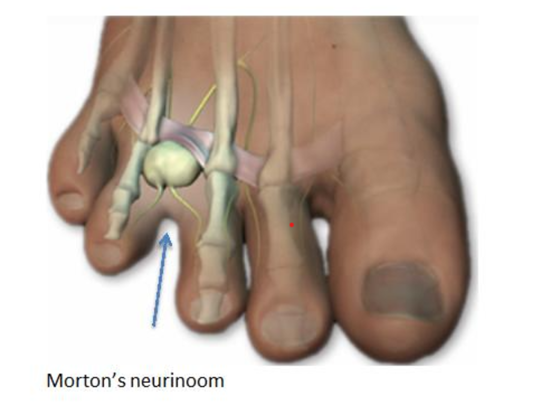 Morton's neurinoom | Orthoclinic - Orthopedie Brugge