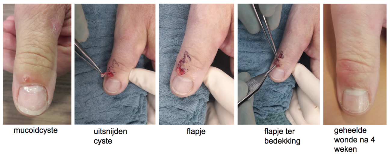 Mucoid cyste | Orthoclinic Brugge