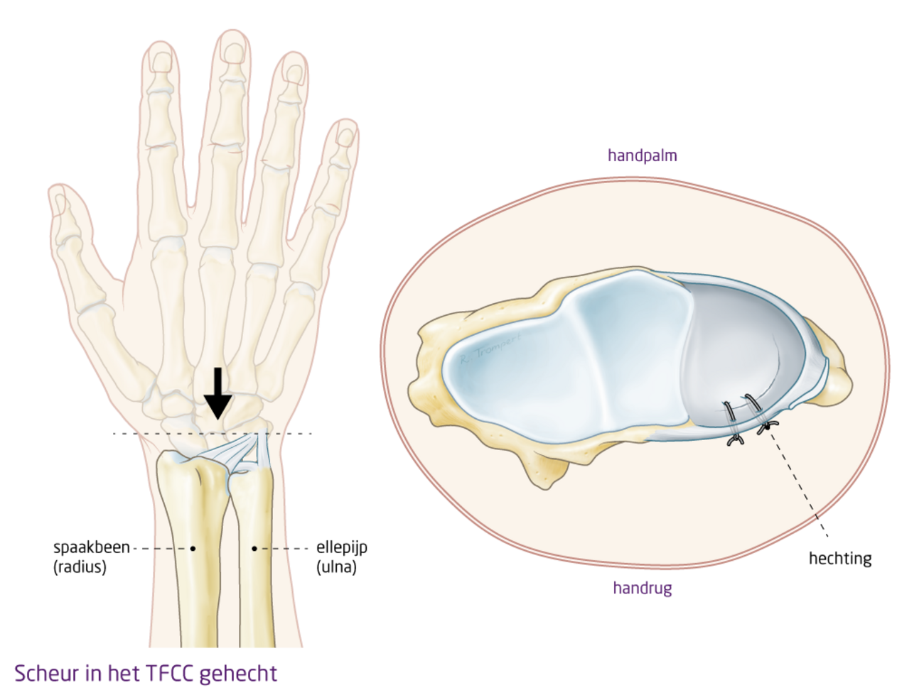 TFCC scheur | Orthoclinic Brugge