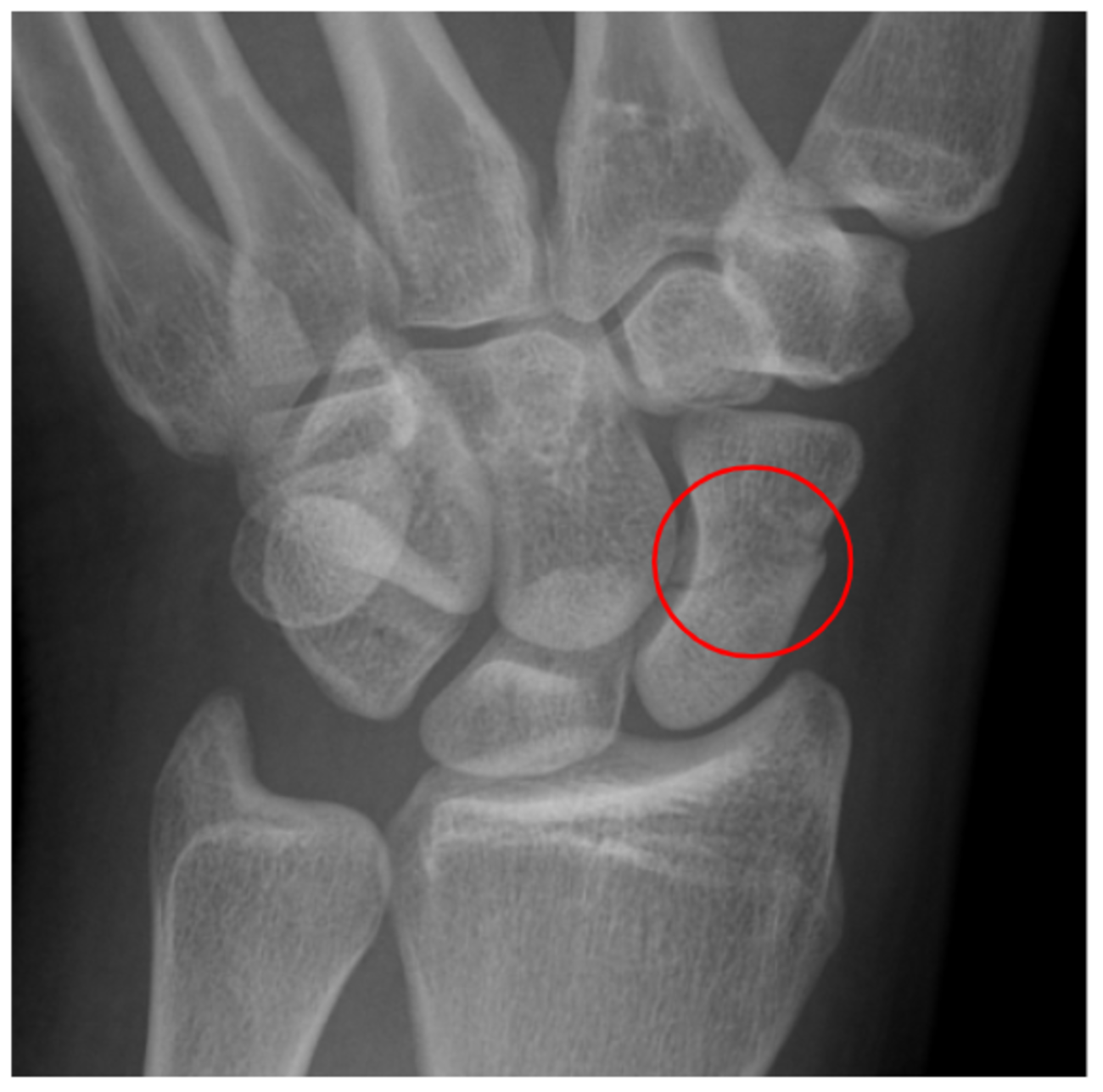 Scafoidfractuur | Orthoclinic Brugge