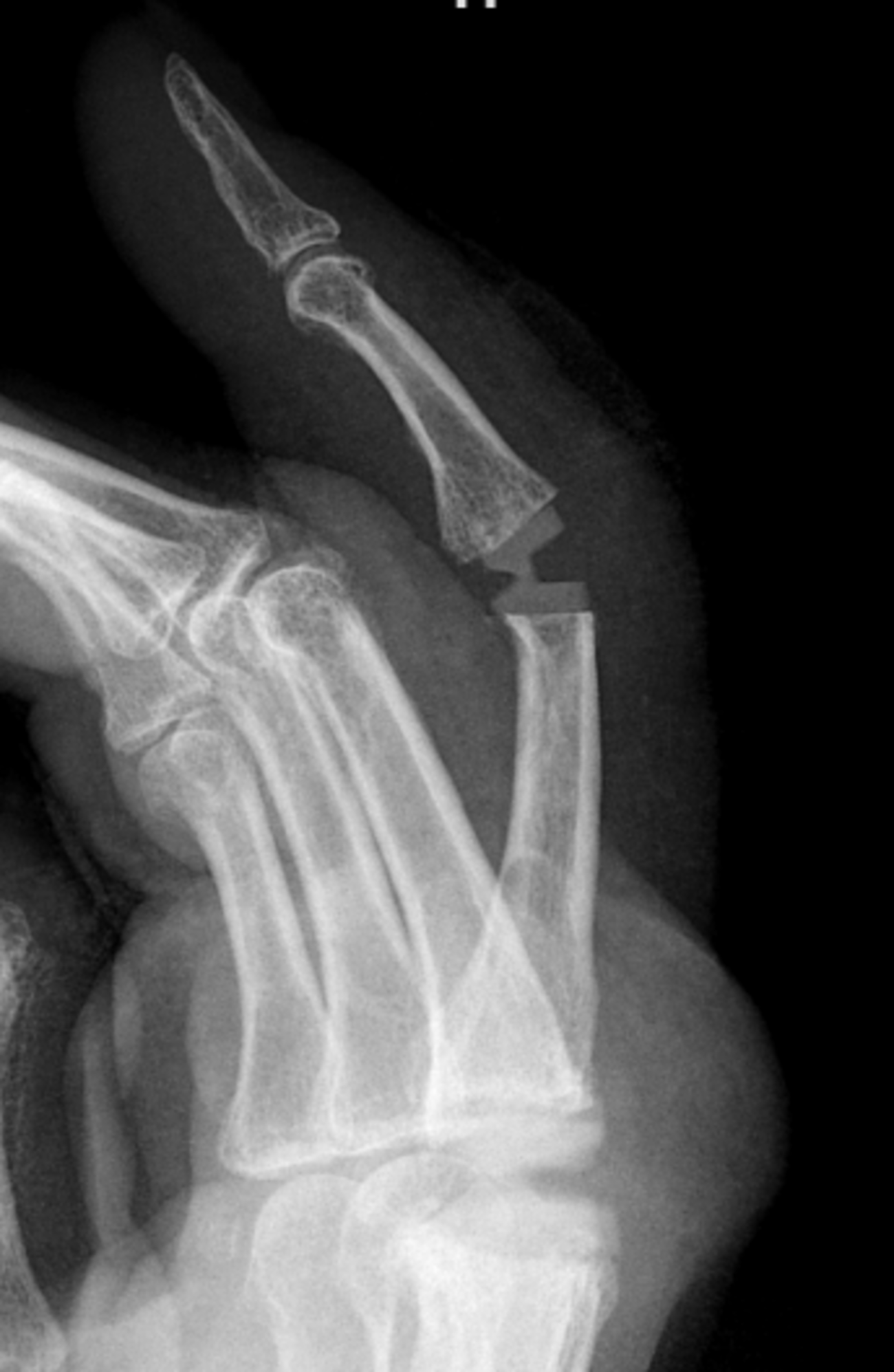 Vingerartrose | Orthoclinic Brugge