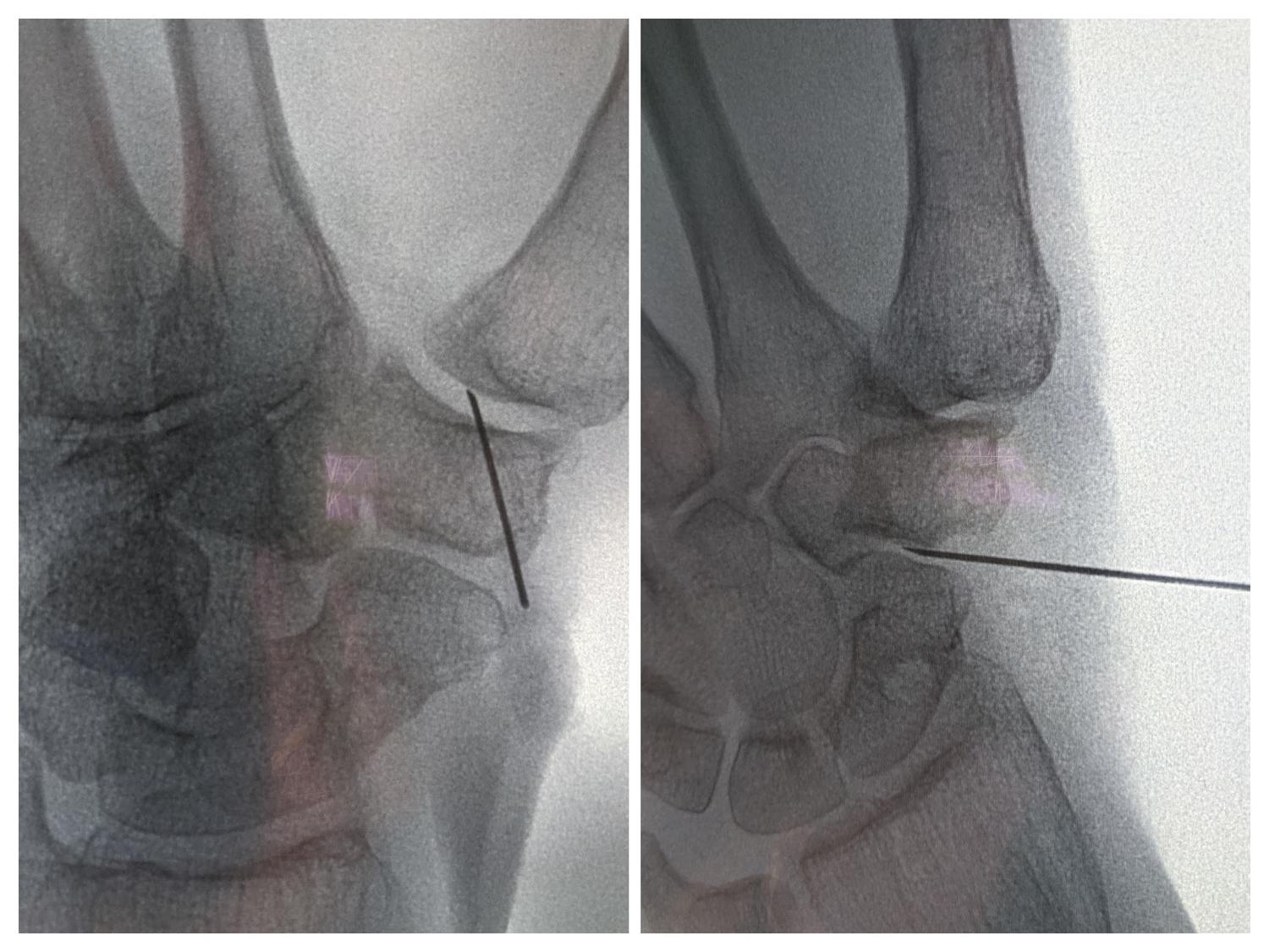 Infiltraties | Orthoclinic - Orthopedie Brugge