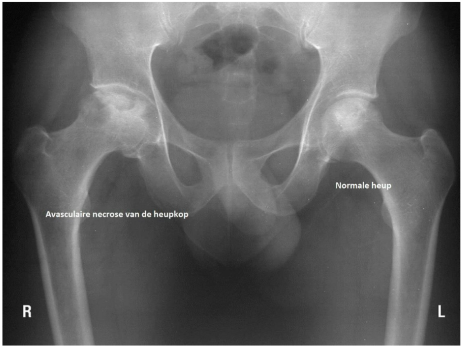 Avasculaire necrose heupkop | Orthoclinic - Orthopedie Brugge