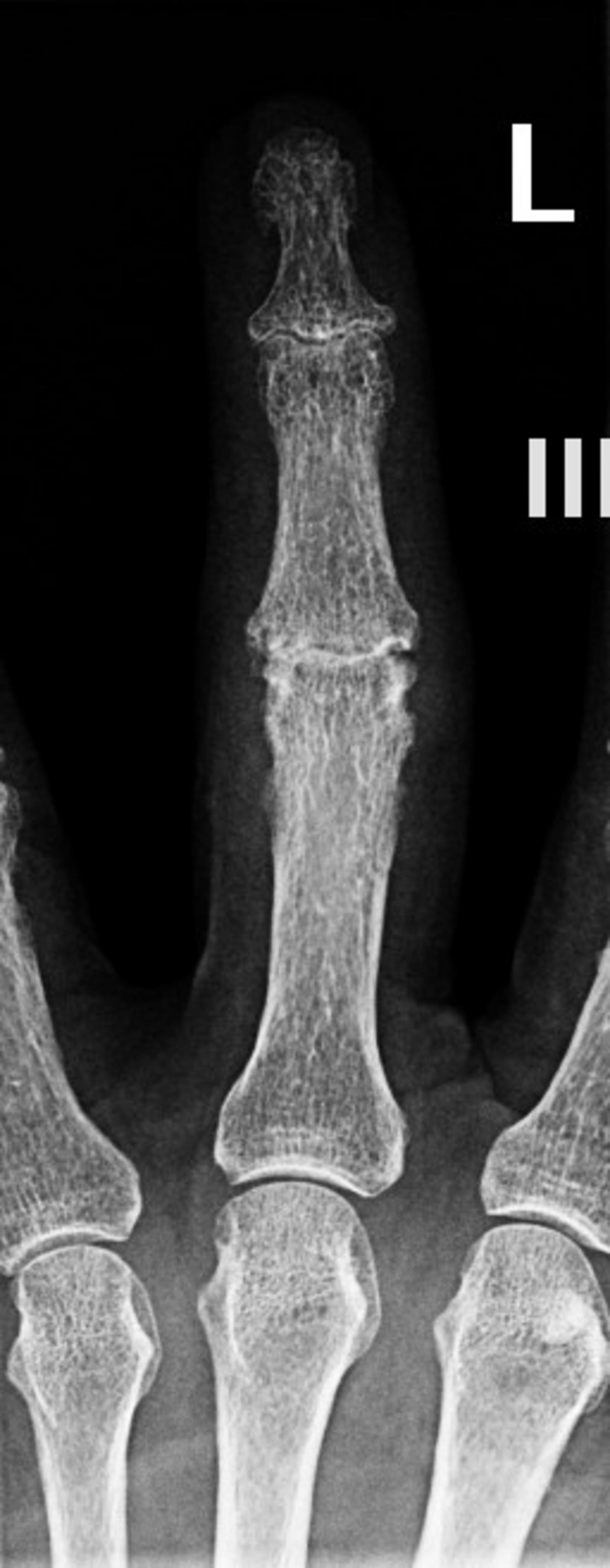 Vingerartrose | Orthoclinic Brugge