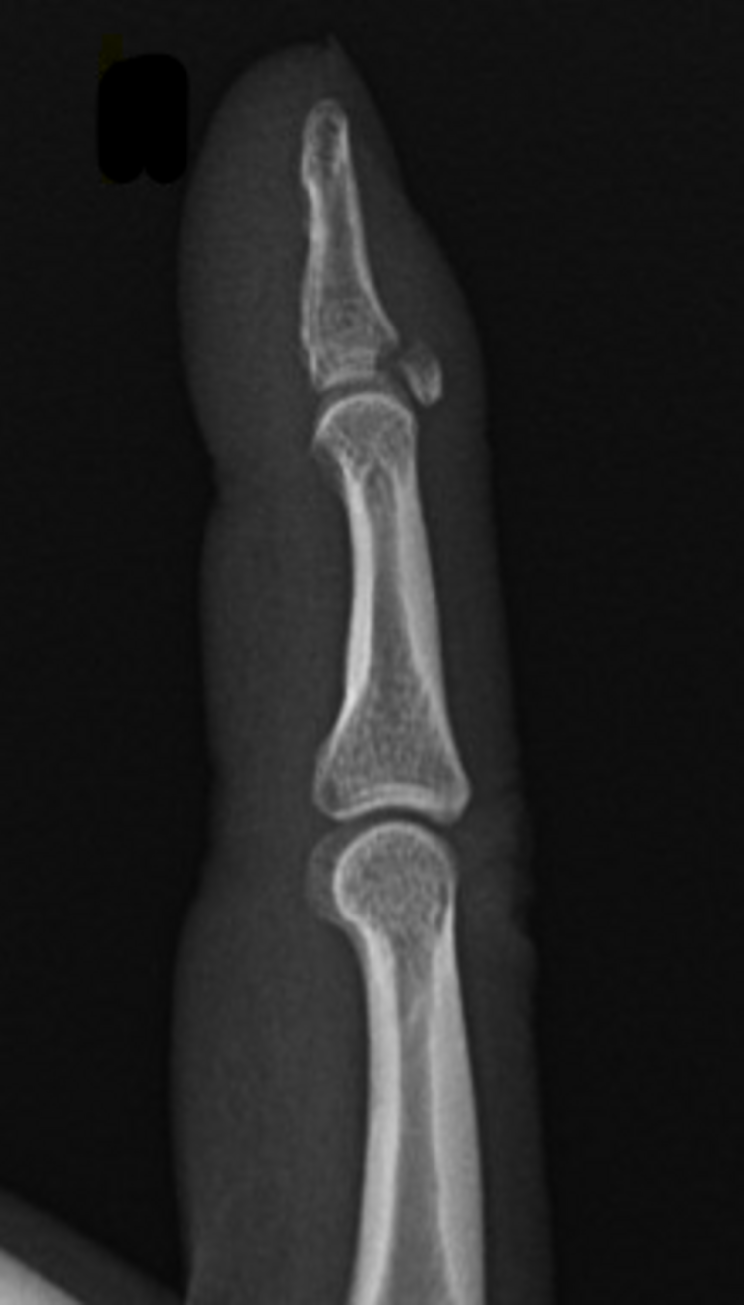 Mallet vinger | Orthoclinic - Orthopedie Brugge