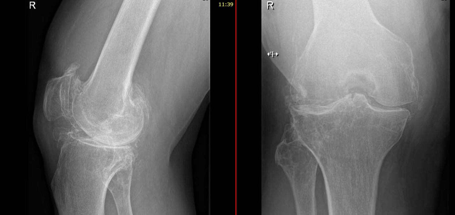 Artrose van de knie | Orthoclinic Brugge