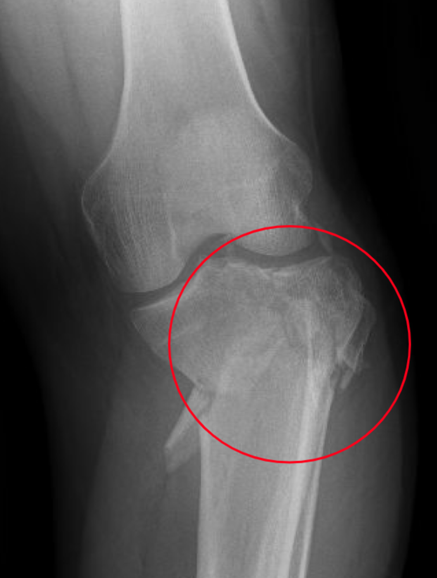 Fracturen rond de knie | Orthoclinic Brugge