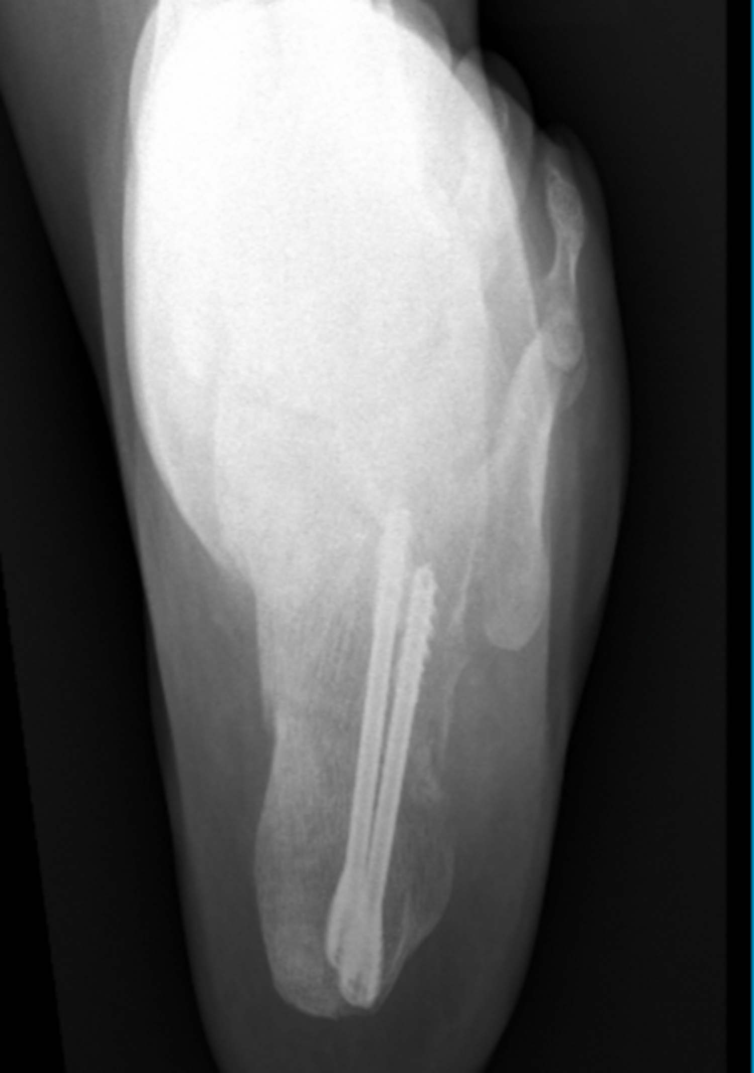 Peroneuspees letsel | Orthoclinic - Orthopedie Brugge