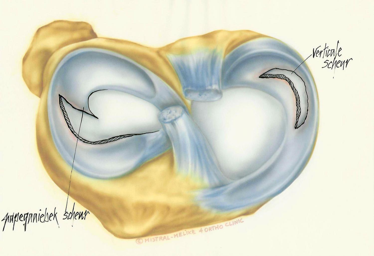 Meniscusscheur | Orthoclinic Brugge