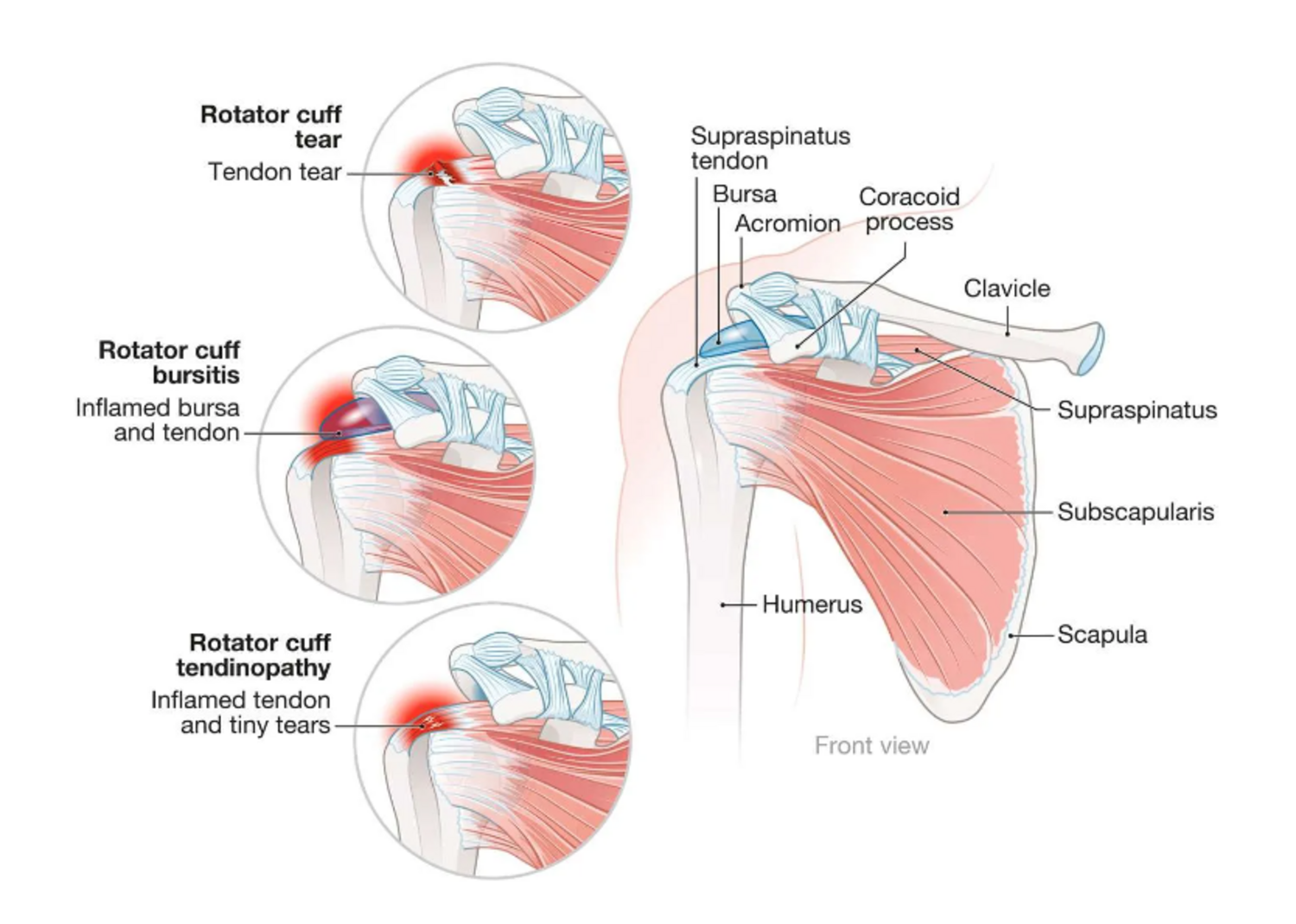 Rotator cuff scheur | Orthoclinic Brugge