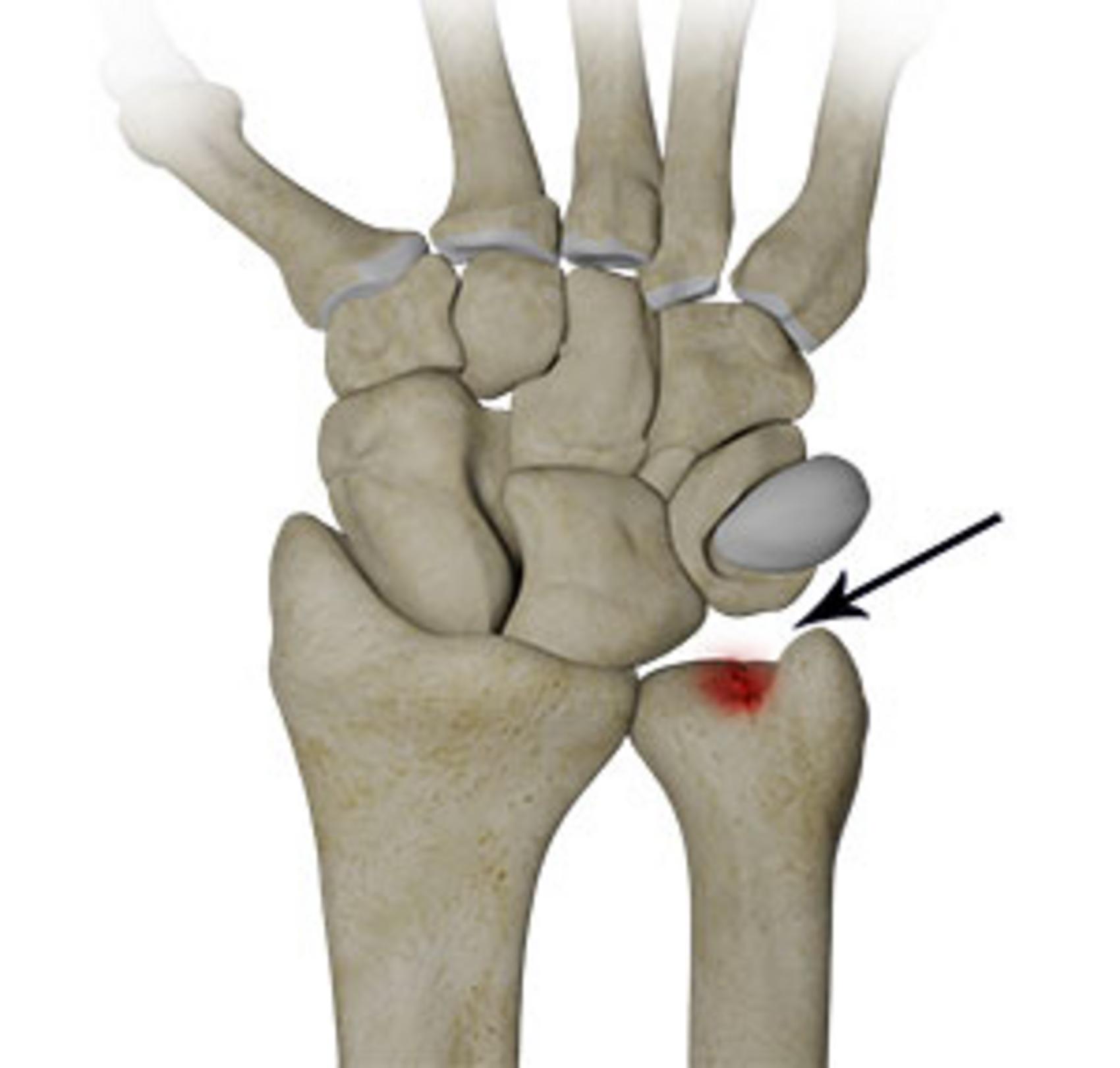 Ulnair impactie syndroom | Orthoclinic - Orthopedie Brugge