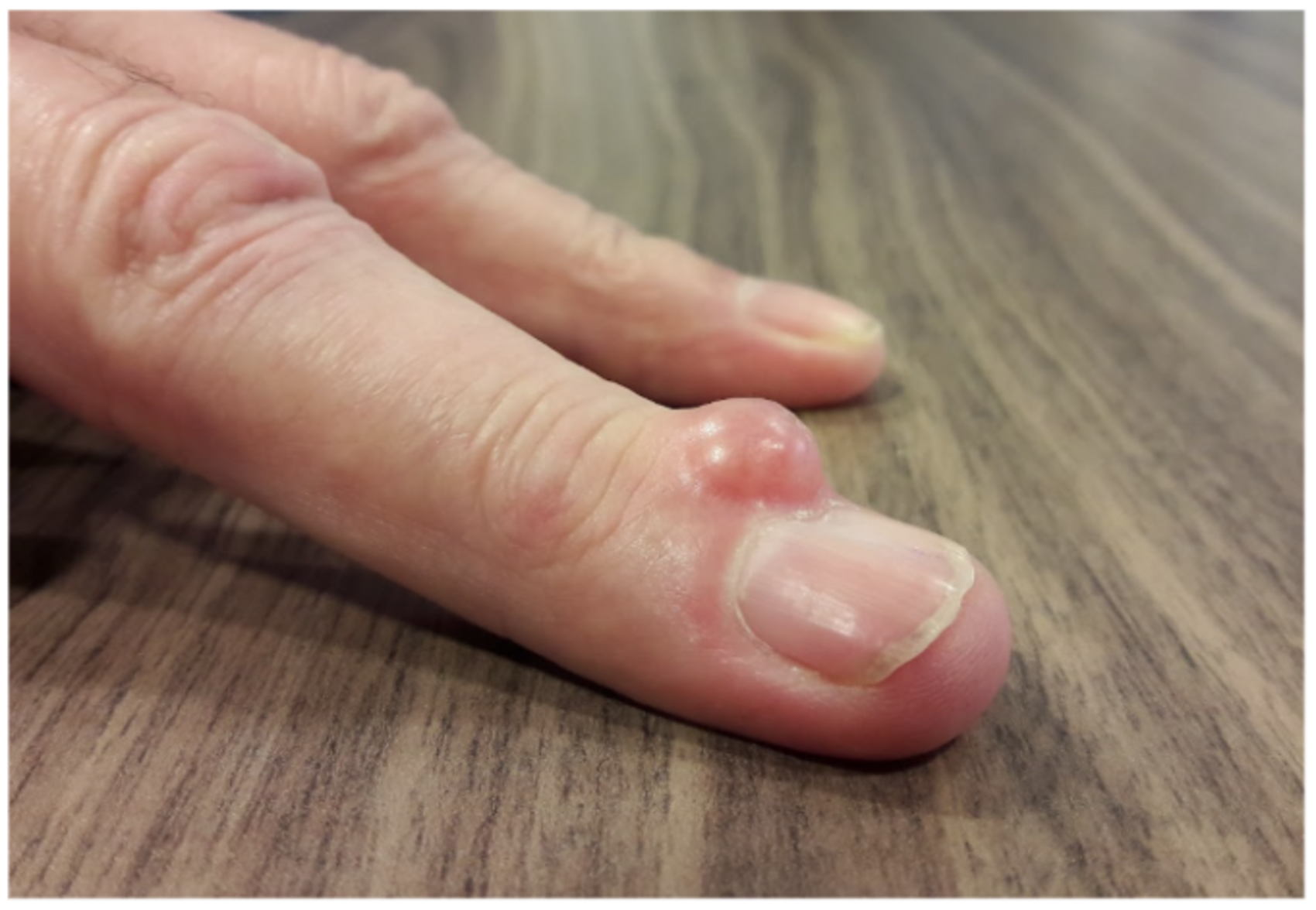 Mucoid cyste | Orthoclinic Brugge