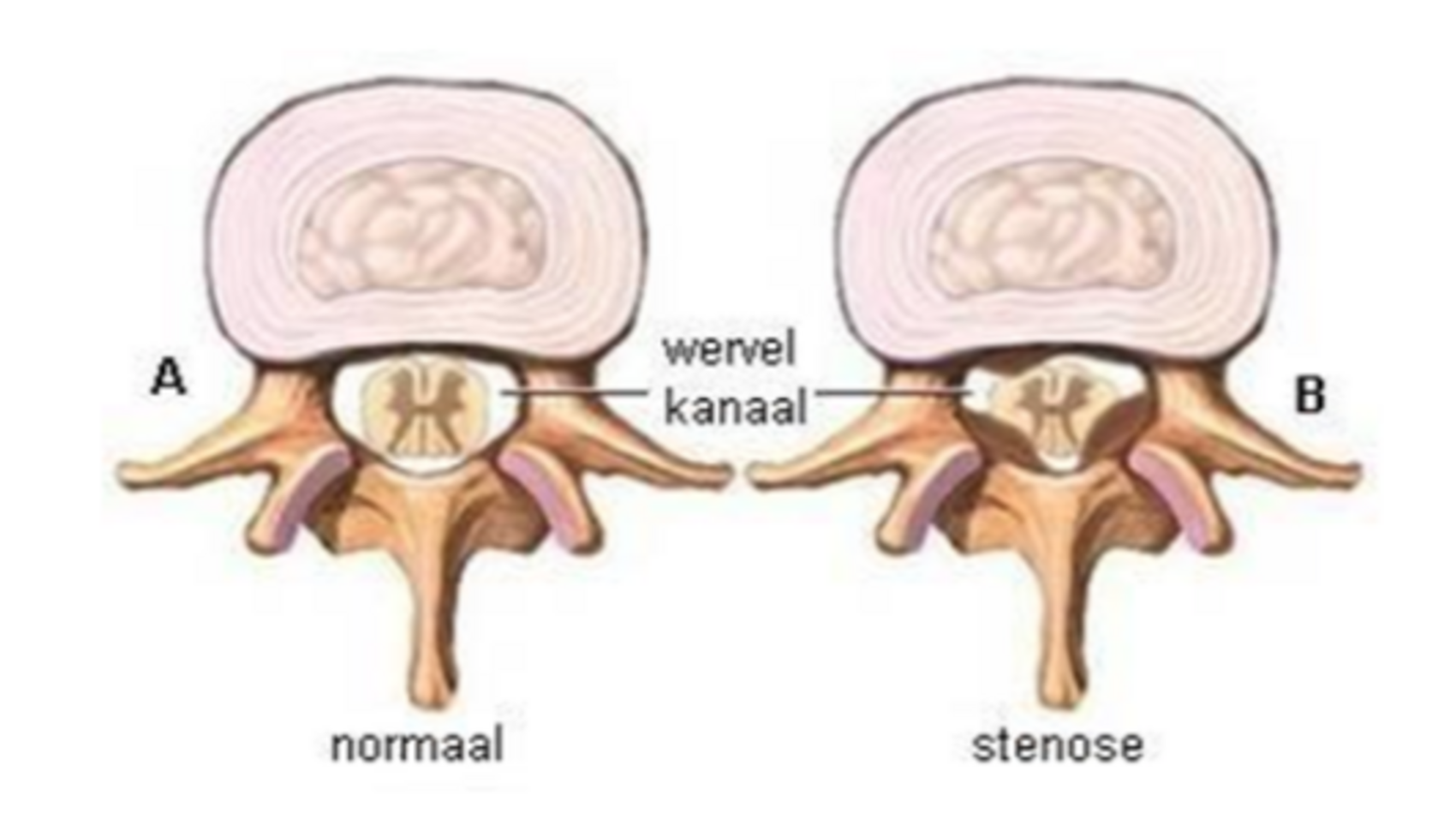 Lumbale spinaal kanaal stenose | Orthoclinic - Orthopedie Brugge