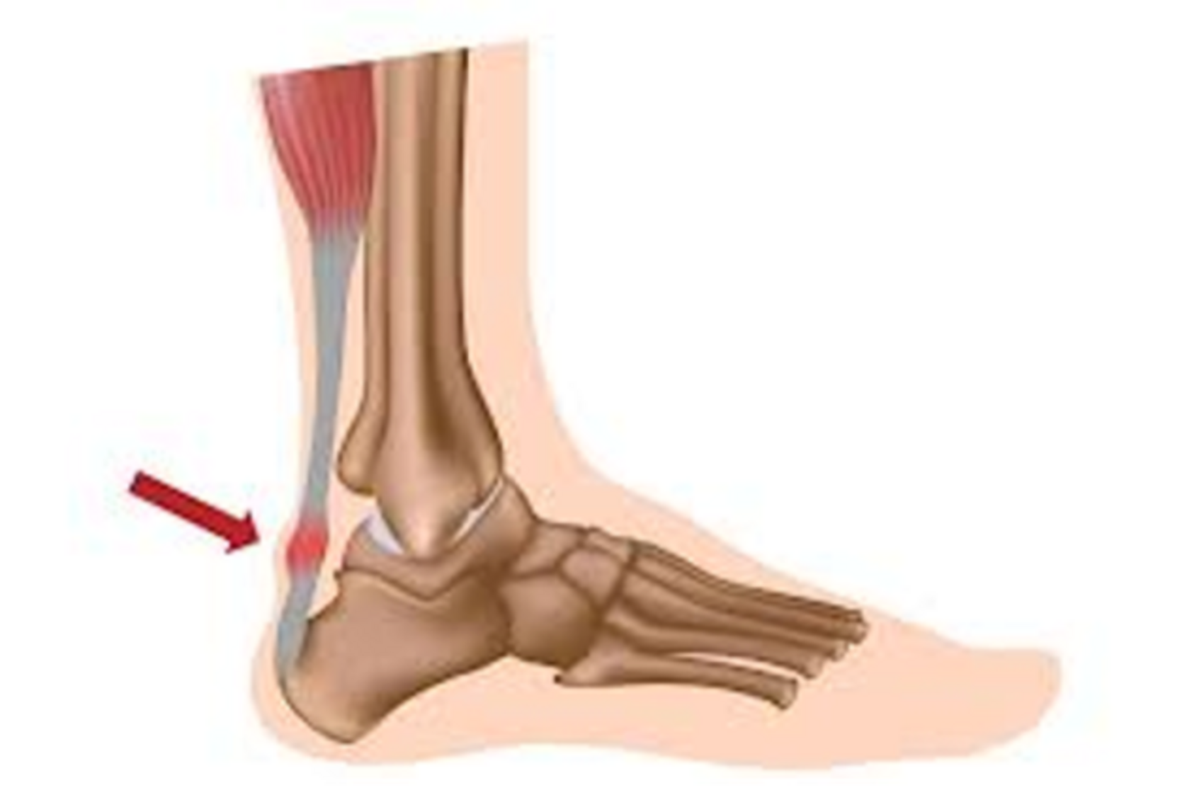 Achillespeesontsteking | Orthoclinic - Orthopedie Brugge