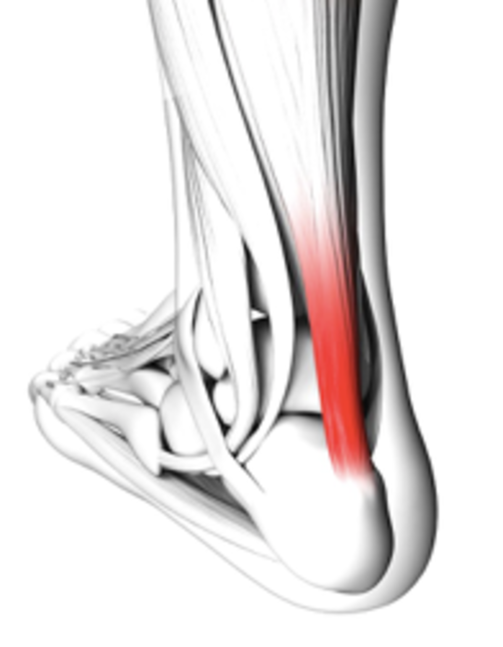 Achillespeesontsteking | Orthoclinic - Orthopedie Brugge