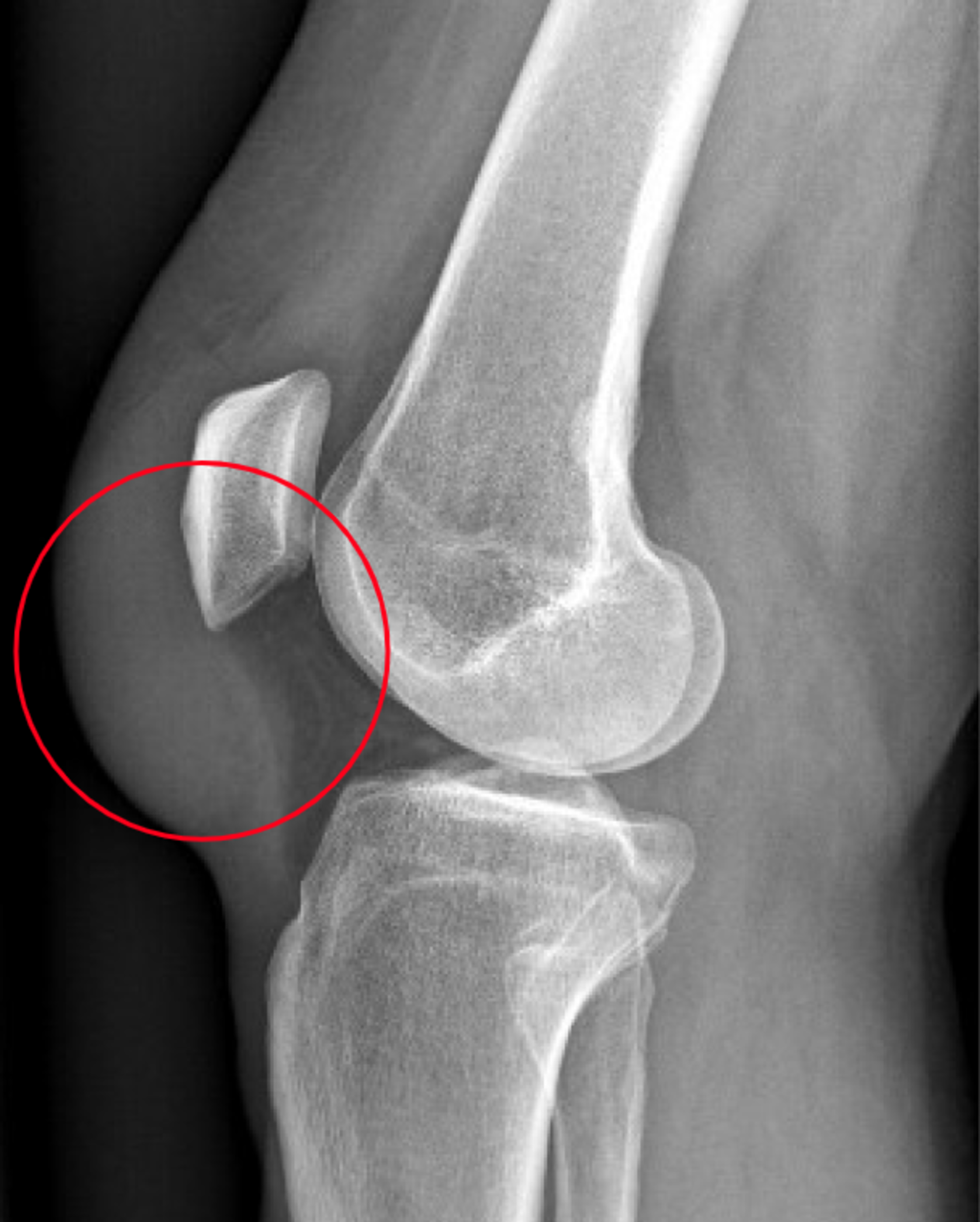 Prepatellaire bursitis | Orthoclinic - Orthopedie Brugge