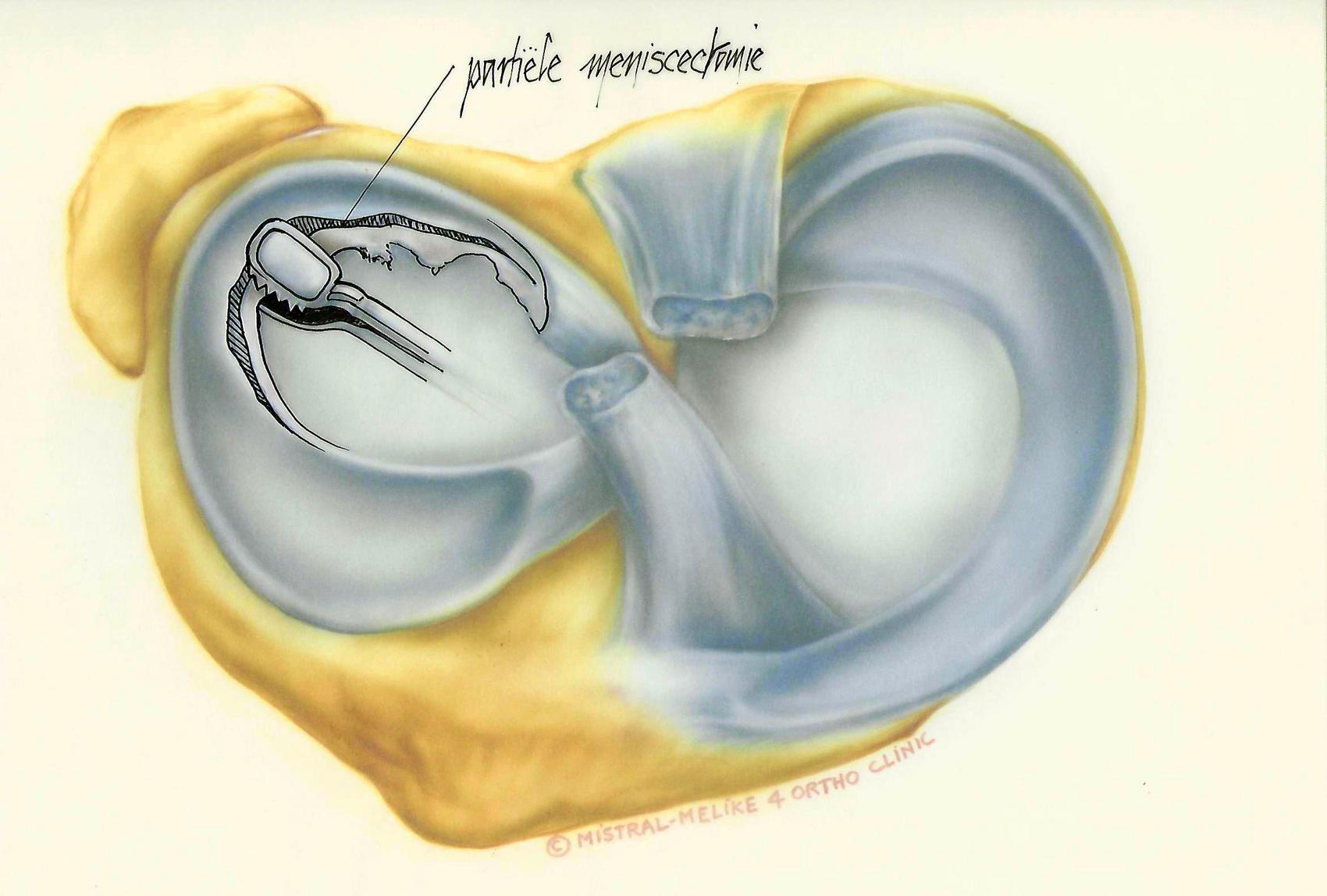 Meniscusscheur | Orthoclinic Brugge