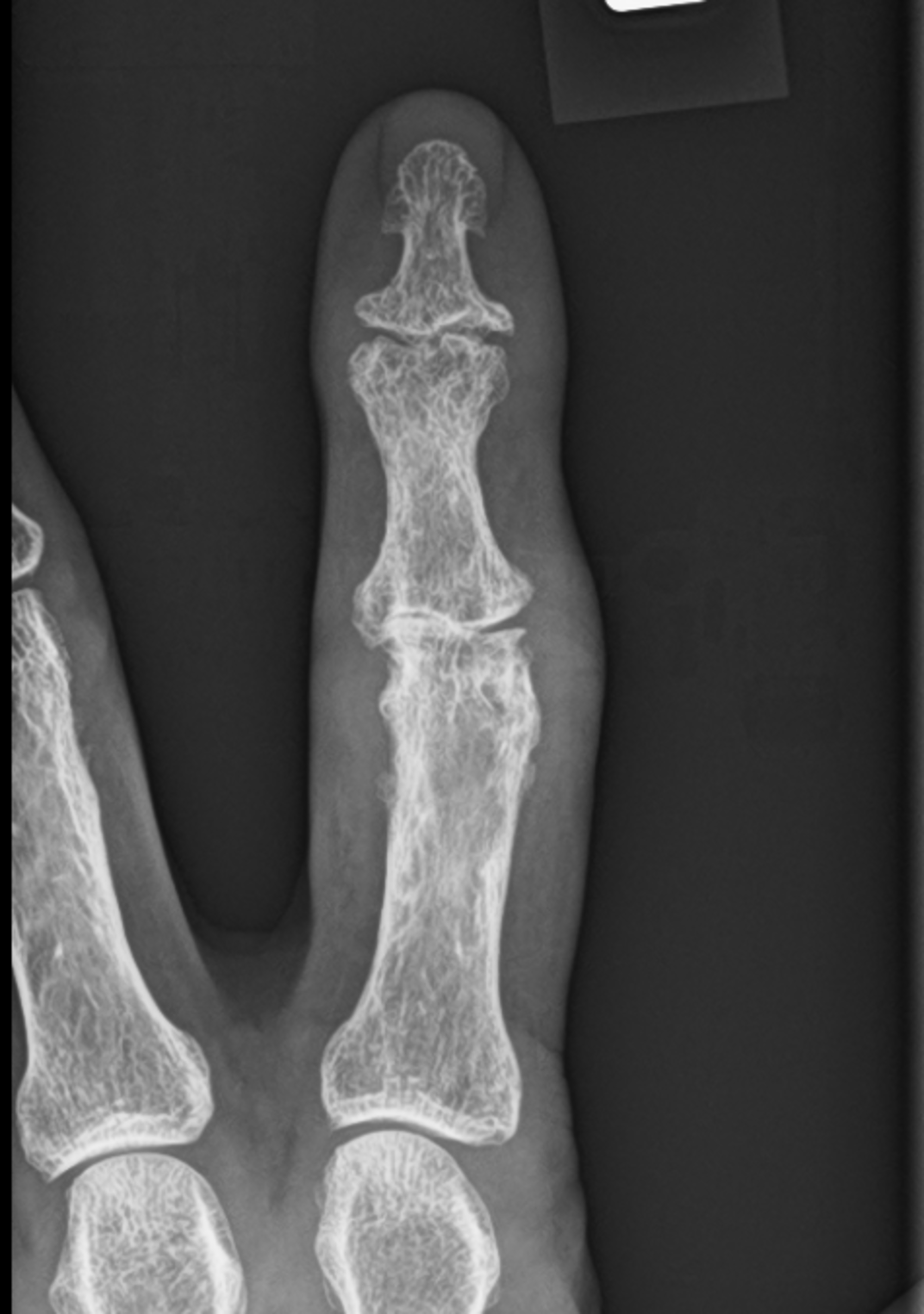 Vingerartrose | Orthoclinic Brugge