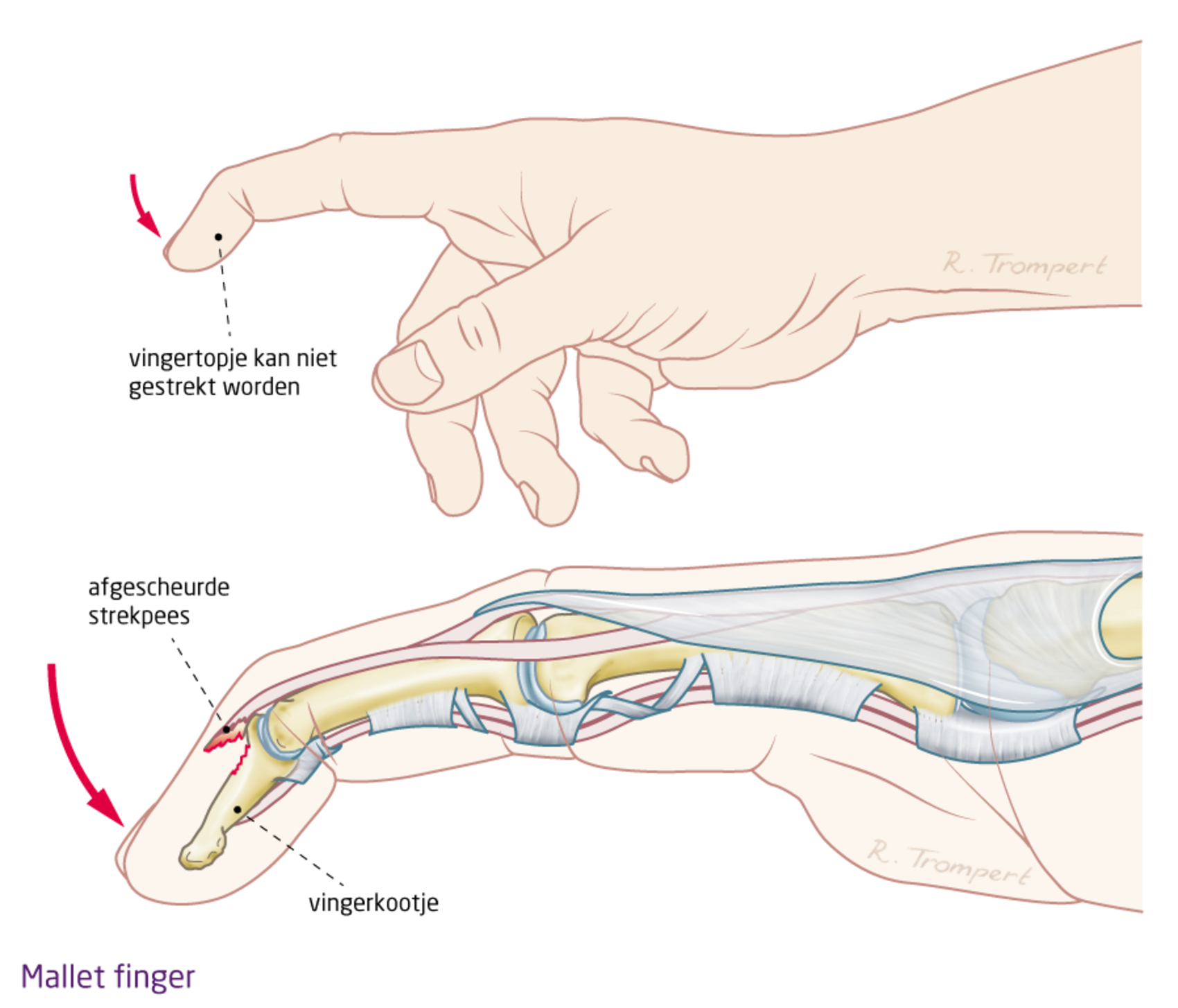Mallet vinger | Orthoclinic - Orthopedie Brugge