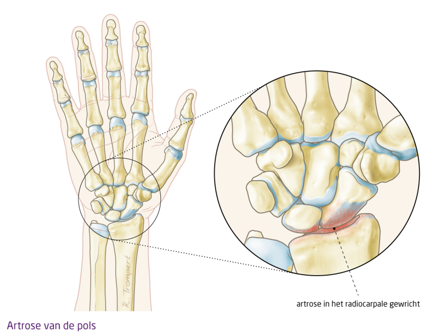 Polsartrose | Orthoclinic Brugge